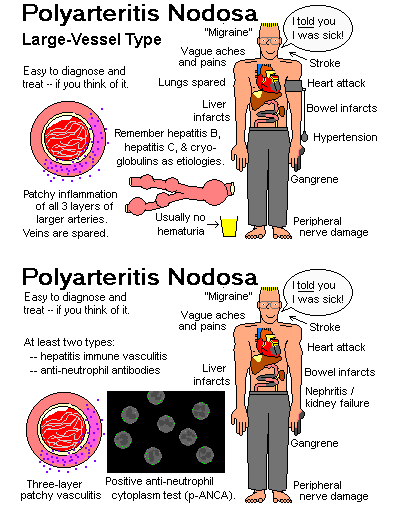 polyarteritis nodosa : 네이버 블로그