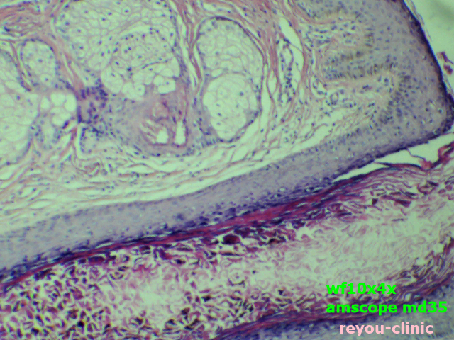 몽고메리 결절(Montgomery's tubercles)의 염증 : 네이버 블로그