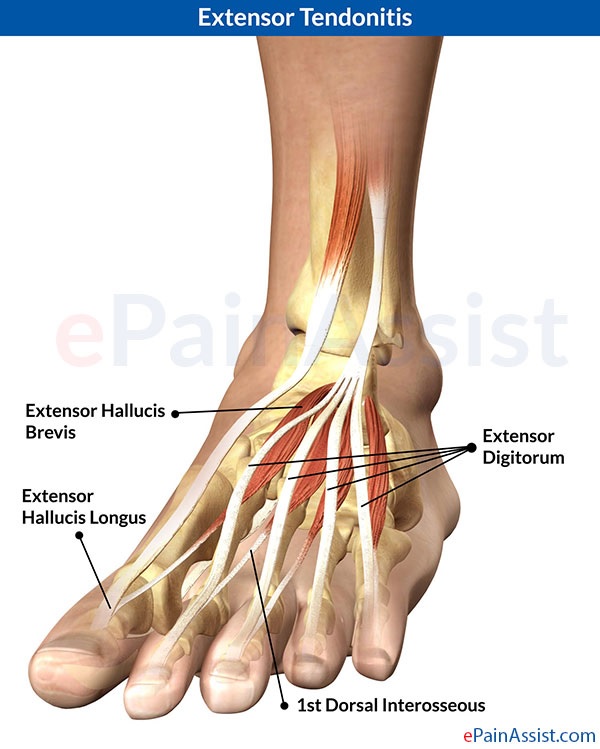 신근건 건초염(Extensor tendinitis, Extensor tendonitis, Extensor ...