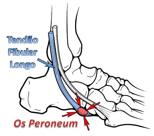 비 부골(Os peroneum, Os peronei) : 런닝을 하고 있는 동안에 발의 외측이 아파요 : 네이버 블로그