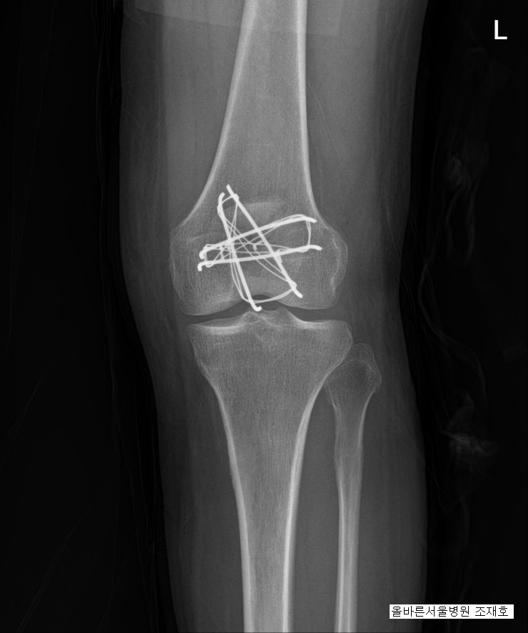 슬개골 분쇄 골절에서의 긴장 강선 고정술(ORIF with tension band wiring at patella ...