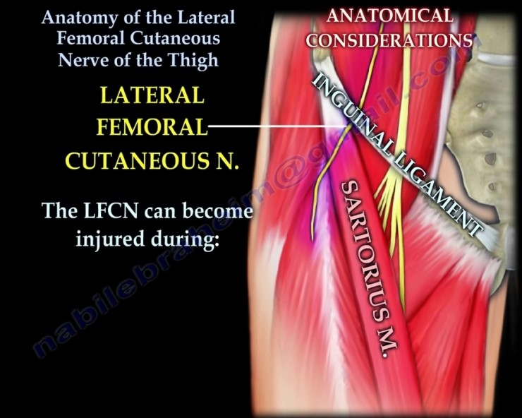 외측대퇴피부신경 포착(lateral femoral cutaneous nerve entrapment) : 네이버 블로그