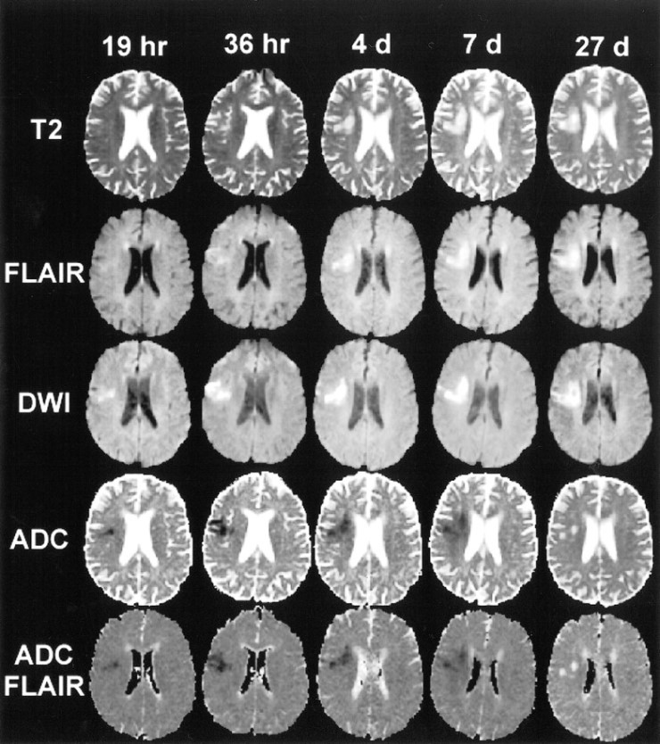 mental change - 강한 자극 통증에만 반응하는 환자 / GCS infarct hemorrhage brain CT ...