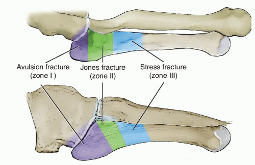 제5 중족골 골절 재활운동 - Jones Fracture, 5th Metatarsal Fracture Rehabilitation ...