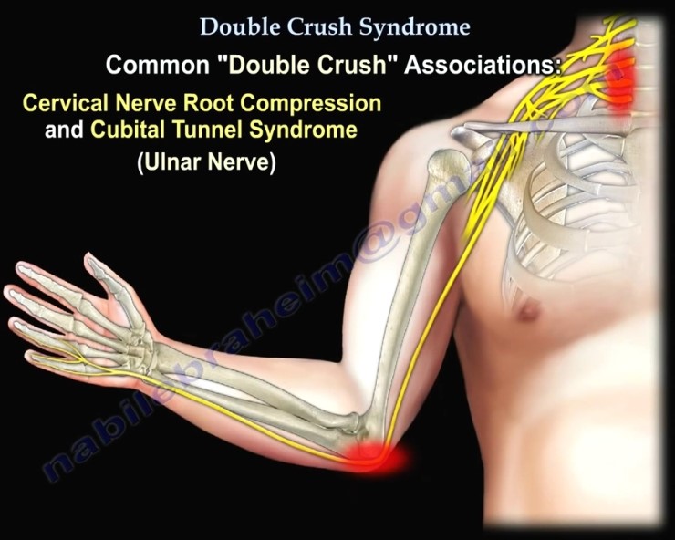 The double crush in nerve entrapment syndromes : 네이버 블로그