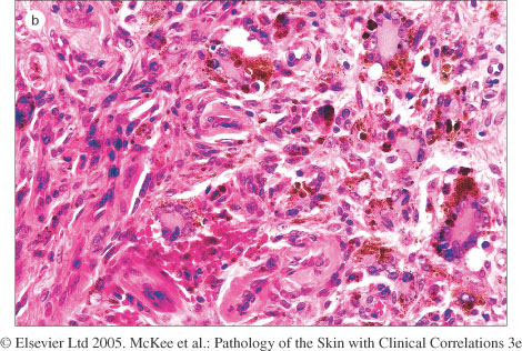 [병리] 피부섬유종의 변이 (Variants of Benign Fibrous Histiocytoma (Dermatofibroma ...