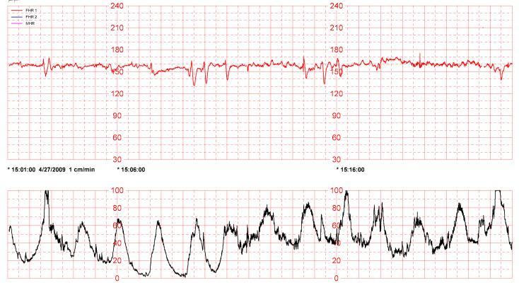 선생님 , 태동검사 안하면 안되나요? : 네이버 블로그