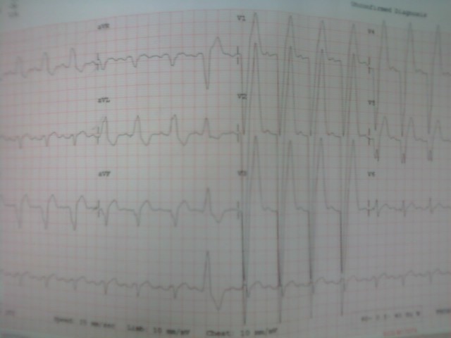 Supraventricular tachycardia c aberrant conduction - SVT와 VT의 감별에 대해서 ...