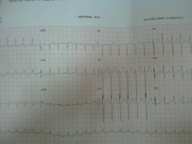 Supraventricular tachycardia c aberrant conduction - SVT와 VT의 감별에 대해서 ...